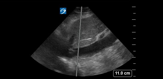 Case 1: Hypotension – POCUS Revolution